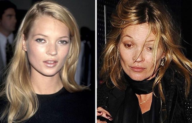 Horrible: 18 Shocking Photos Of Famous Celebrities Before And After Drugs Addiction - GhPage
